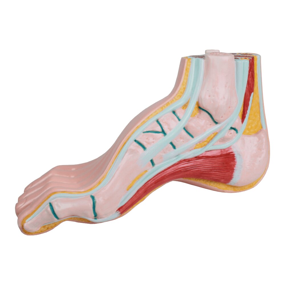 Erler-Zimmer Hohlfuß-Modell | pes cavus | medial eröffnet