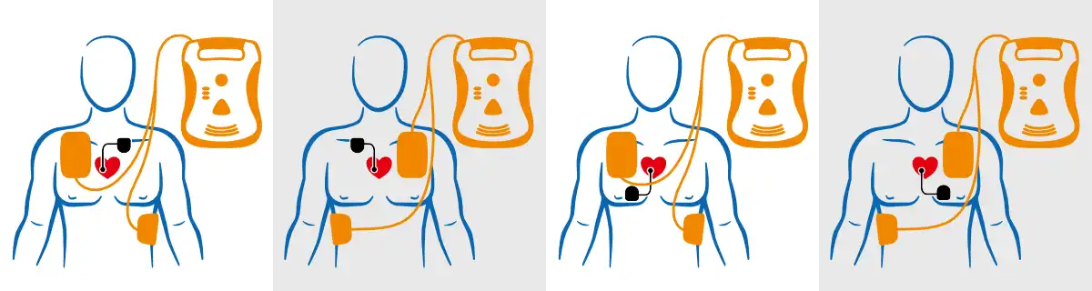 Defi Pads kleben - Anleitung & Tipps | medplus-Ratgeber